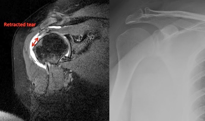 Shoulder and Elbow Surgery: Three cases of rotator cuff surgery. Mini ...