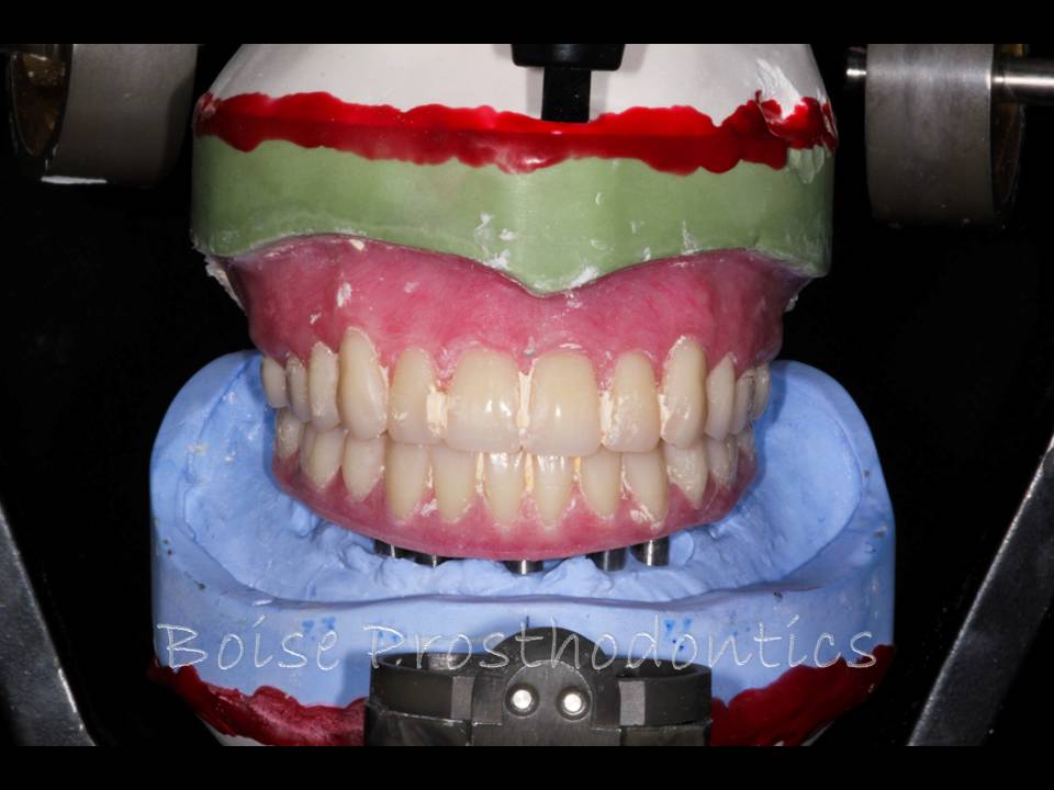 Boise Idaho Prosthodontics: Picture Sequence of Maxillary Complete ...