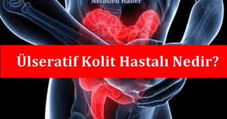 Ülseratif Kolit Hastalığı Nedir? belirtileri ve tedavisi - Netbilen Haber