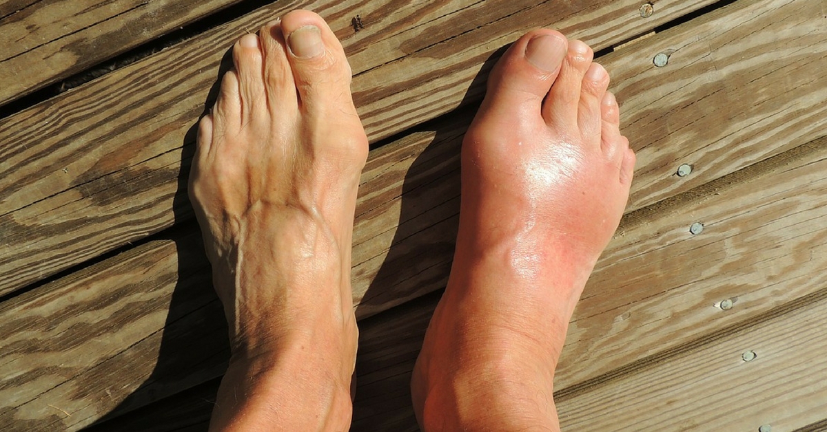 8 Reasons Why Your Health Maybe In Danger If You Have Swollen Feet 8 Reasons Why Your Health Maybe In Danger If You Have Swollen Feet