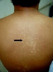 Petua dan Cara Hilangkan Panau | Beli Vitamin Shaklee