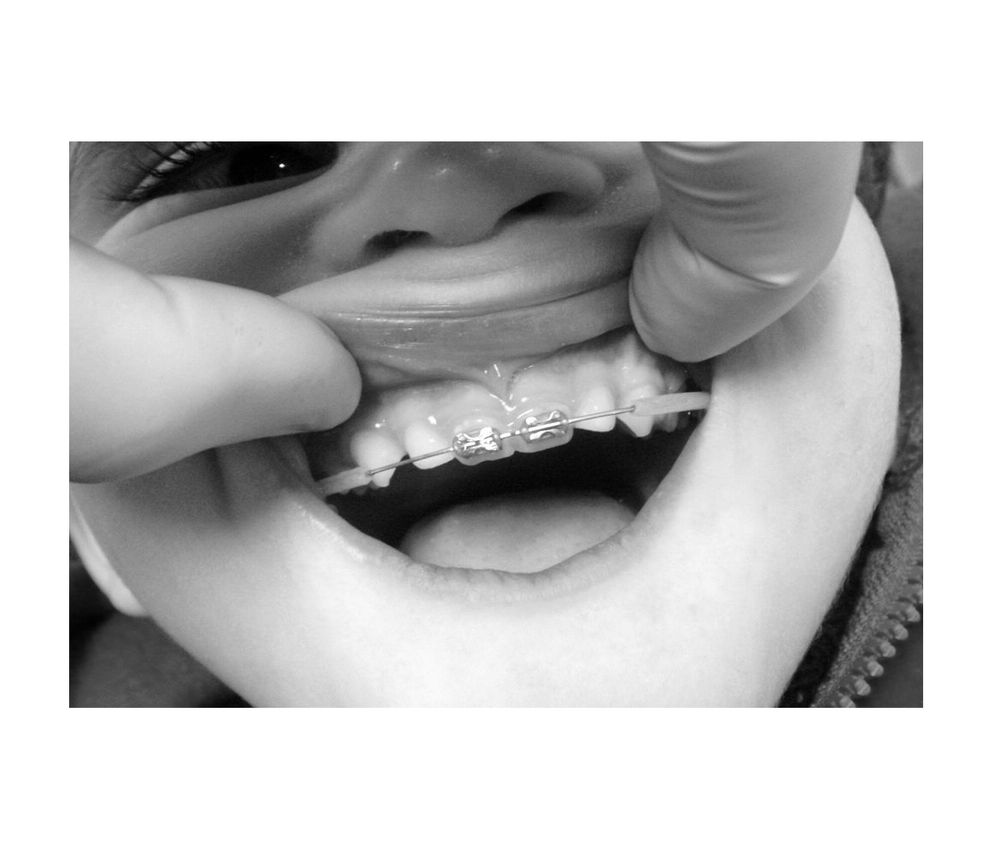 Pseudo class III treatment in 2-year-old children - OdontoVida