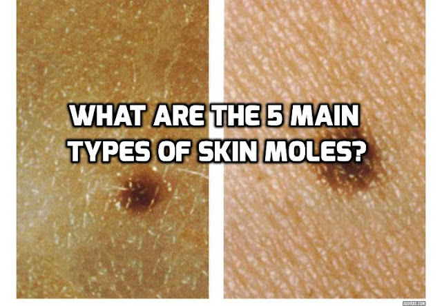 How To Have a Healthy Life: Yes! Revealing Here 5 Main Types of Skin Moles
