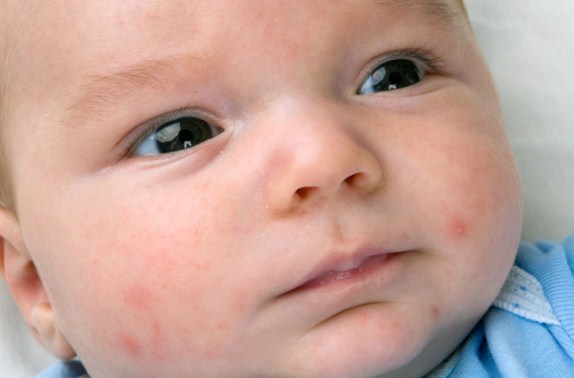 Penyebab dan Cara Mengatasi Bercak Putih Pada Kulit dan Wajah Bayi ...