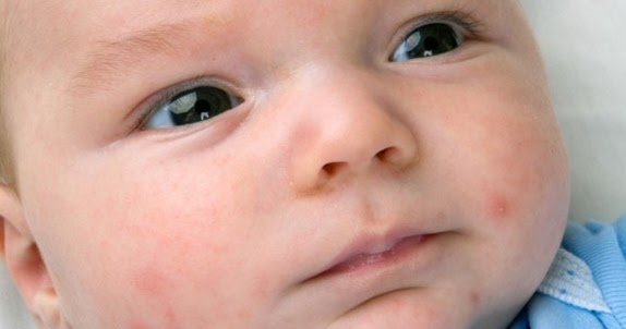 Penyebab dan Cara Mengatasi Bercak Putih Pada Kulit dan Wajah Bayi ... Penyebab dan Cara Mengatasi Bercak Putih Pada Kulit dan Wajah Bayi ...