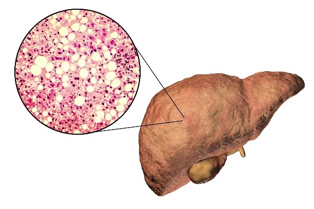 Non Alcoholic Fatty Liver Disease - Causes, Symptoms and Treatments