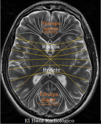 El Baúl Radiológico: EL CUERPO CALLOSO NORMAL. VARIANTES ANATÓMICAS ...