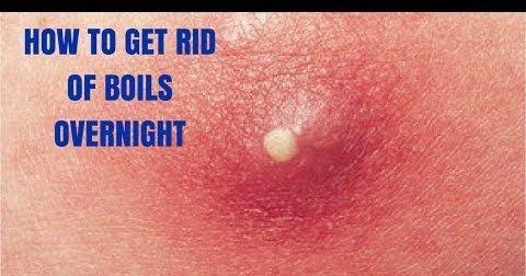 Boils TREATMENT PLAN Herbal 2020 - Home Health Hub