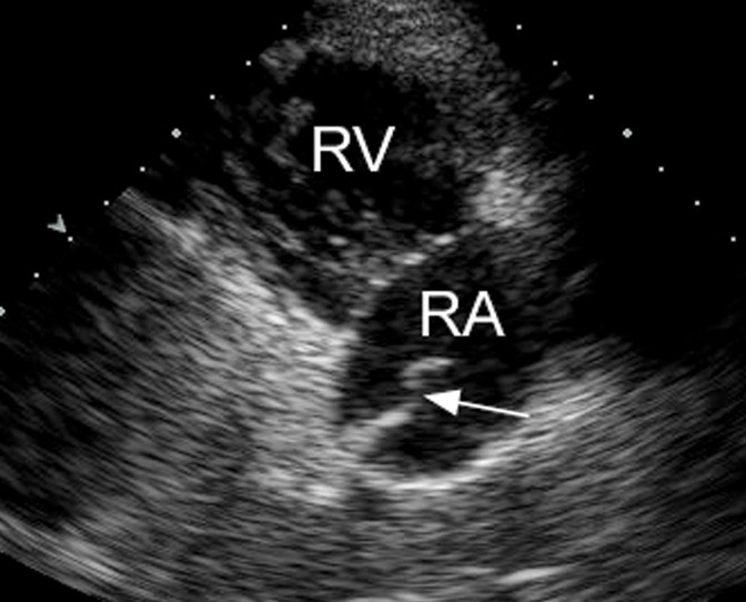 Eustachian Valve on RV Inflow View of Echocardiogram