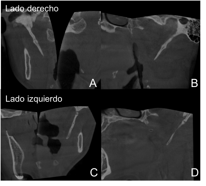 CIDEM: APÓFISIS ESTILOIDES ELONGADA