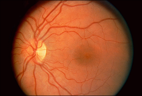 YOU SHOULD KNOW?: RETINA