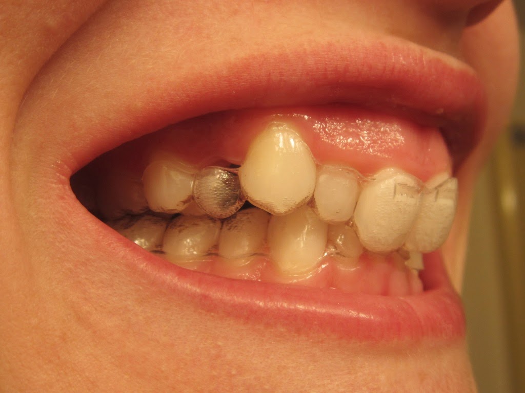Creatively Titled Blog about Invisalign: Third Trays