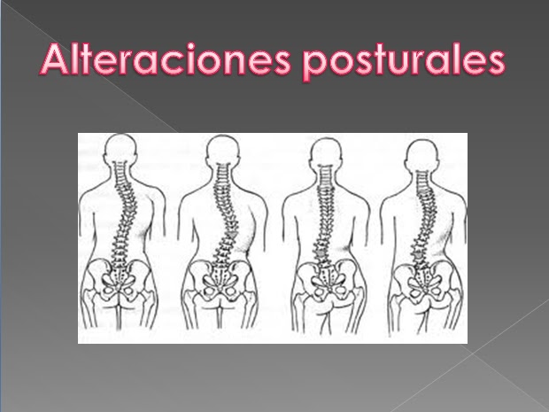 Blog informativo: Alteraciones Posturales