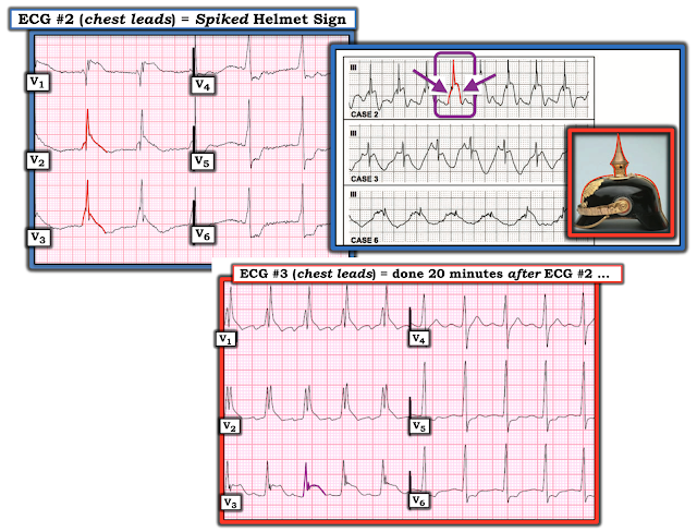 Dr. Smith's ECG Blog: June 2020