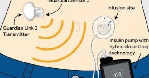 ARTIFICIAL PANCREAS JUST WON FDA APPROVAL....