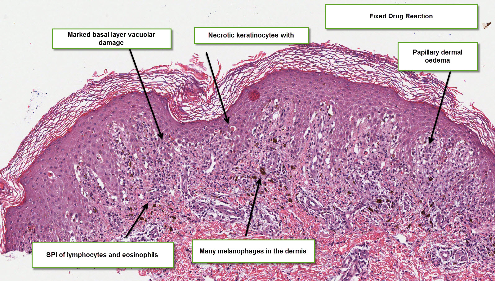 Dermatopathology Made Simple - Inflammatory: Interface - Vacuolar ...
