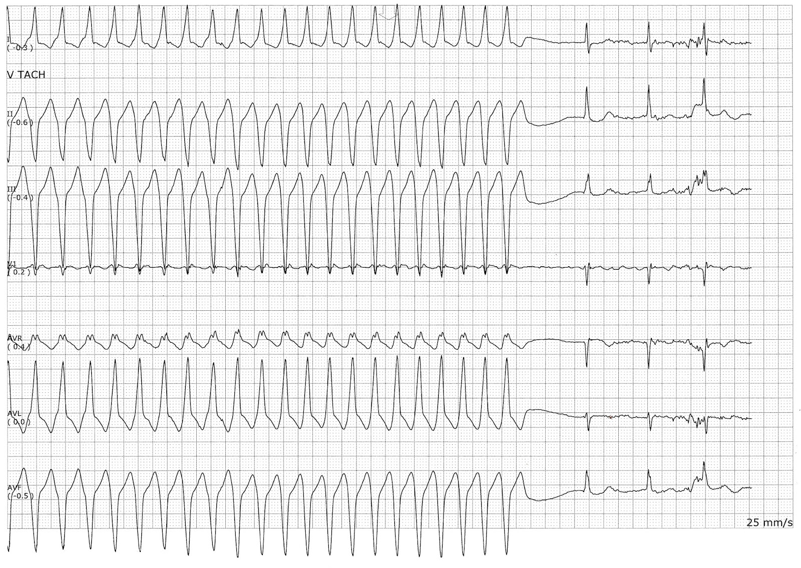 Ventricular Fibrillation