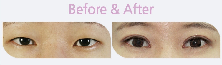 BK Plastic Surgery: [BK Plastic Surgery] Eyelid surgery:Inner Corner ...