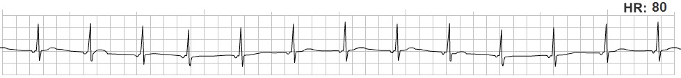 Belajar EKG PREMATURE JUNCTIONAL COMPLEX (PJC), JUNCTIONAL RHYTM ...