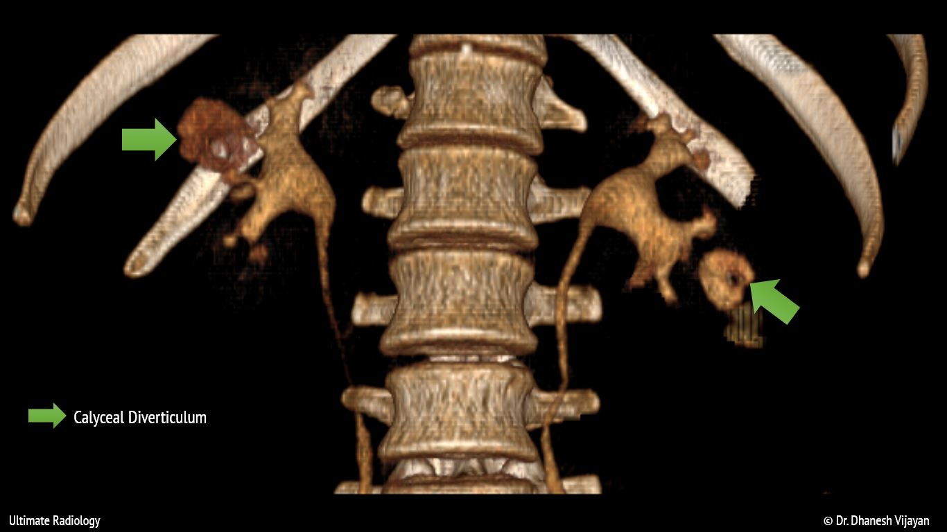 Ultimate Radiology : Calyceal Diverticulum