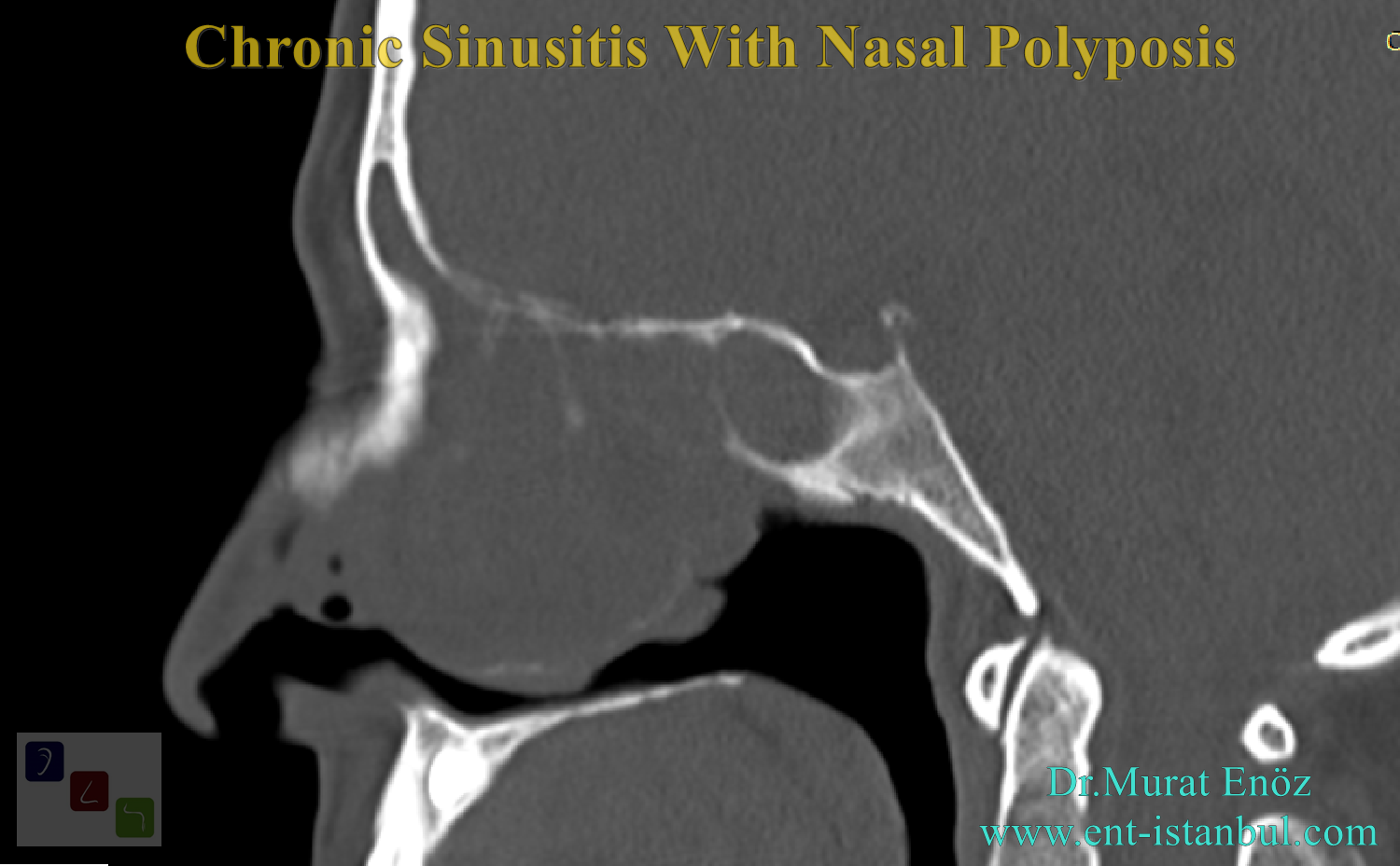 Health Zone Turkey: In Which Situations Is Paranasal Sinus Tomography ...