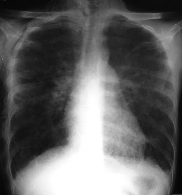 CVT Medical Students: Emphysematous lungs/ Pneumothorax/ Subcutaneous ...