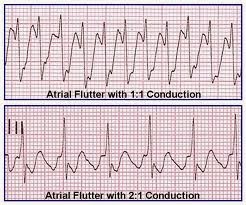 Atrial Flutter: Heart Diseases Causes Symptoms Types Prevention ...