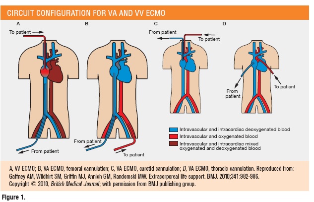 edutainment society: เครื่องช่วยพยุงการทำงานของหัวใจและปอด (ECMO)ที่ ...