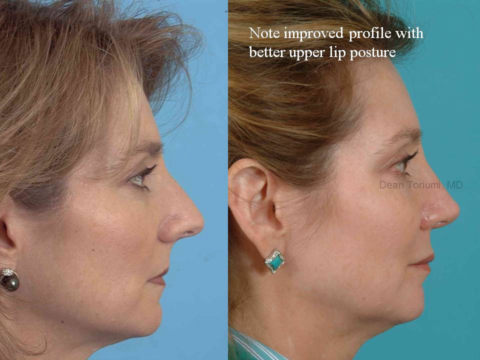 Dr. Dean Toriumi Reviews: Dean Toriumi Reviews: Patient presented for ...