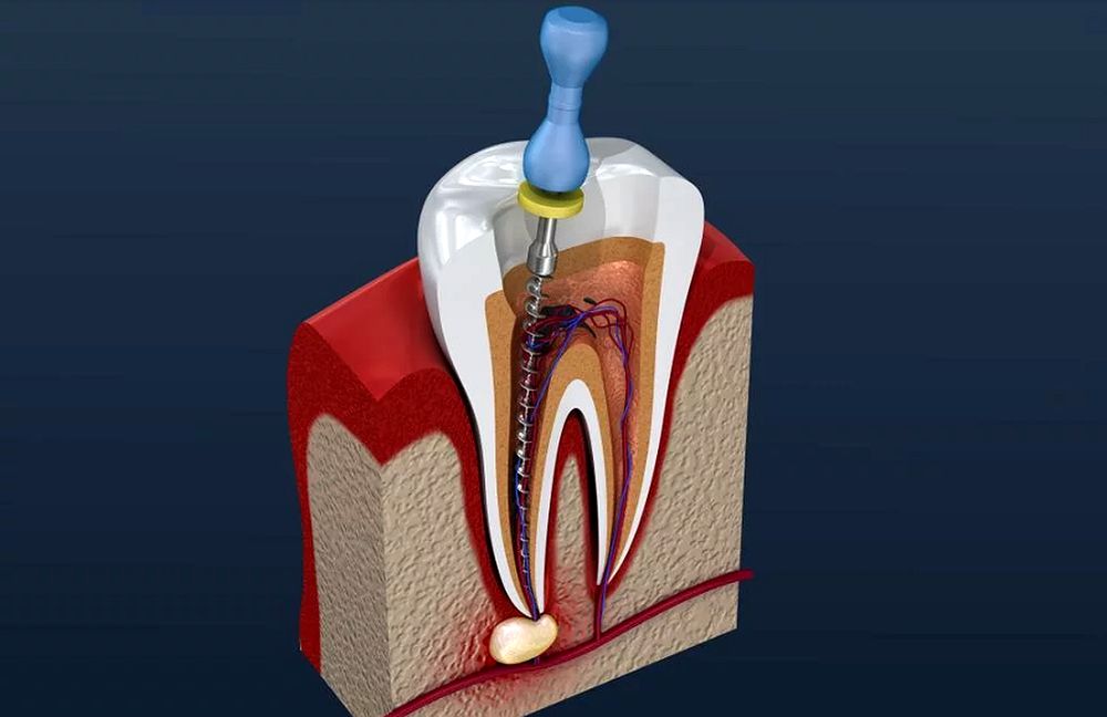 Endodoncia : ¿Necesito tratamiento de conducto? | Directorio Odontológico