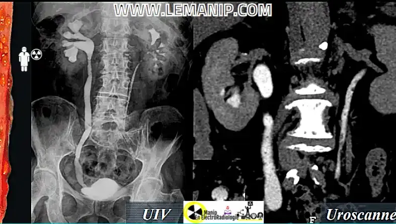 L’UroScanner Sur Mesure : Etude De La Voie Excrétrice