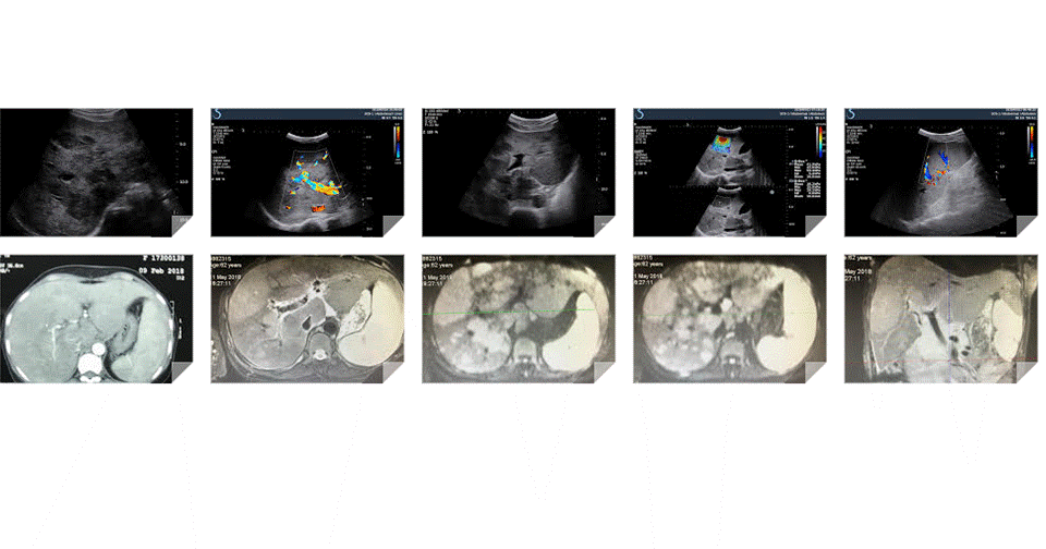 VIETNAMESE MEDIC ULTRASOUND: CASE 494: PRIMARY LIVER LYMPHOMA (PLL),Dr ...