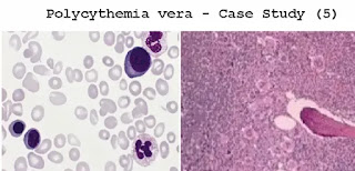 Case Study (5)- Polycythemia vera