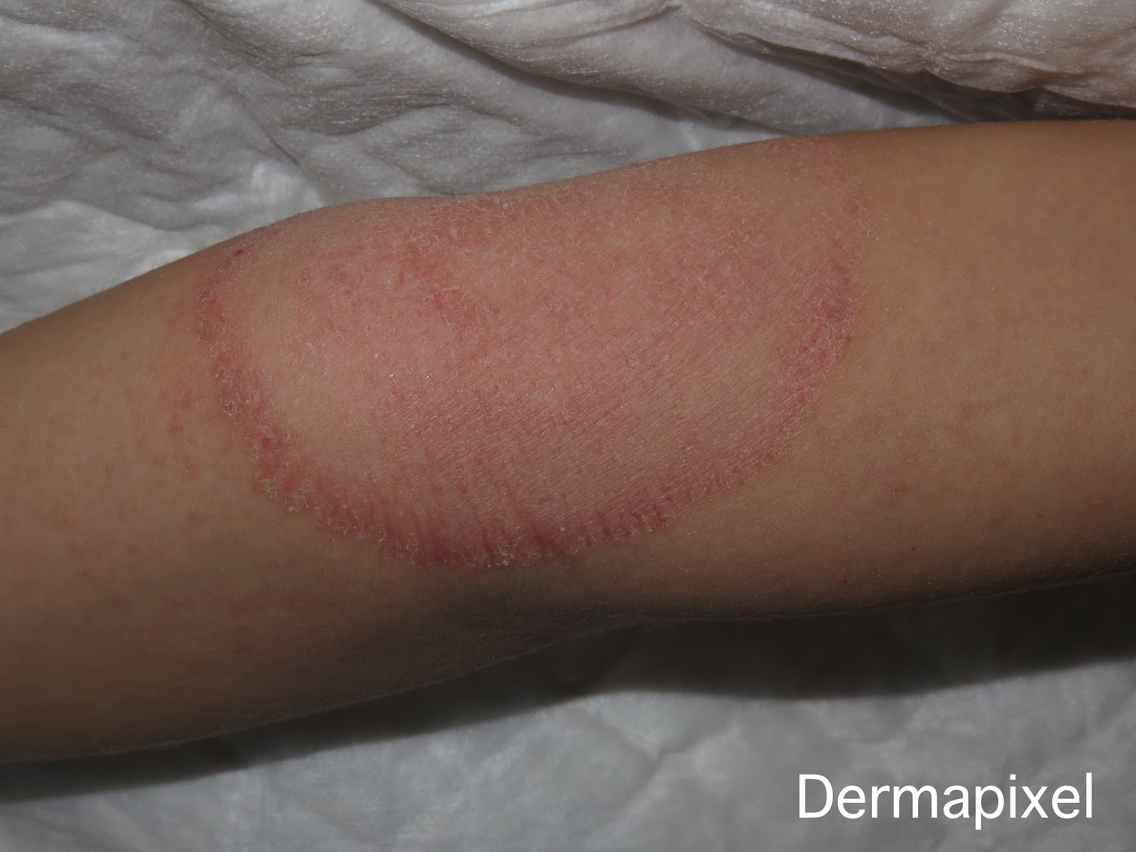 Dermapixel: Un eccema en expansión