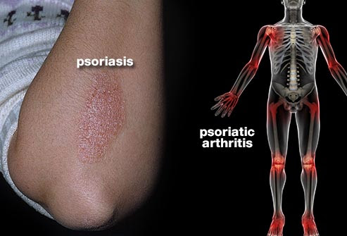 Psoriatic Arthritis: Types, Symptoms and Diagnosis