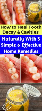 How to Heal Tooth Decay & Cavities Naturally With 3 Simple and ...