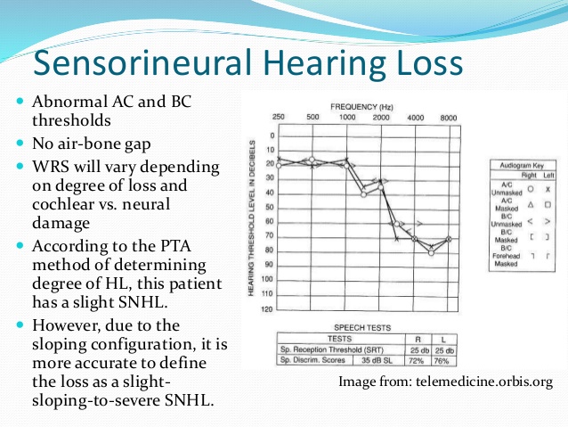 HEARING LOSS , AUDIOGRAM INTERPRETATION
