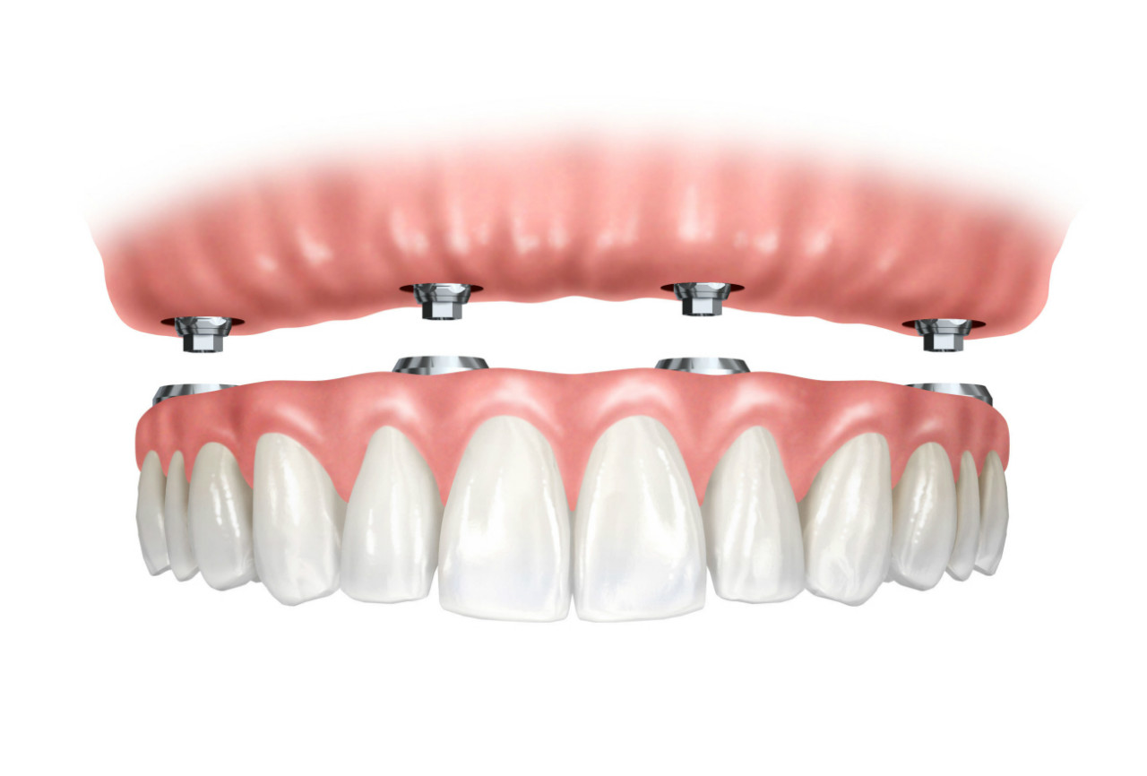 Prótese dentaria fixa em implantes dentários ~ Dentopolis