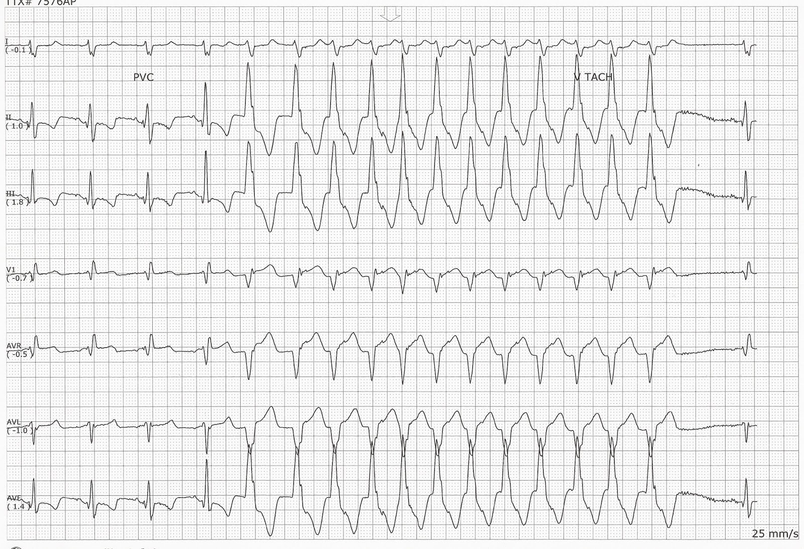 Float Nurse: Sinus rhythm with a run of ventricular tachycardia