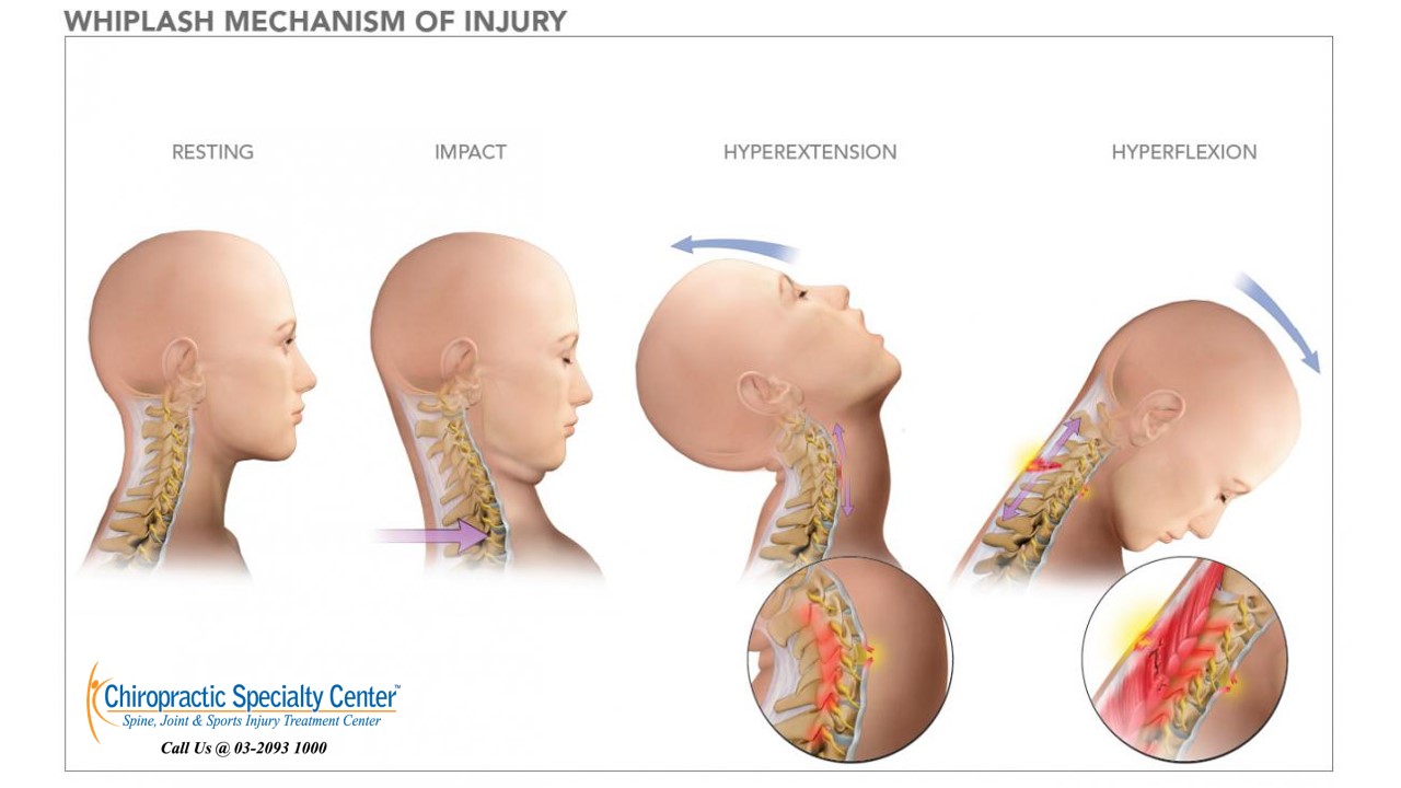 Whiplash Injury