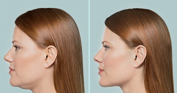 5 Things You Need To Know About Kybella