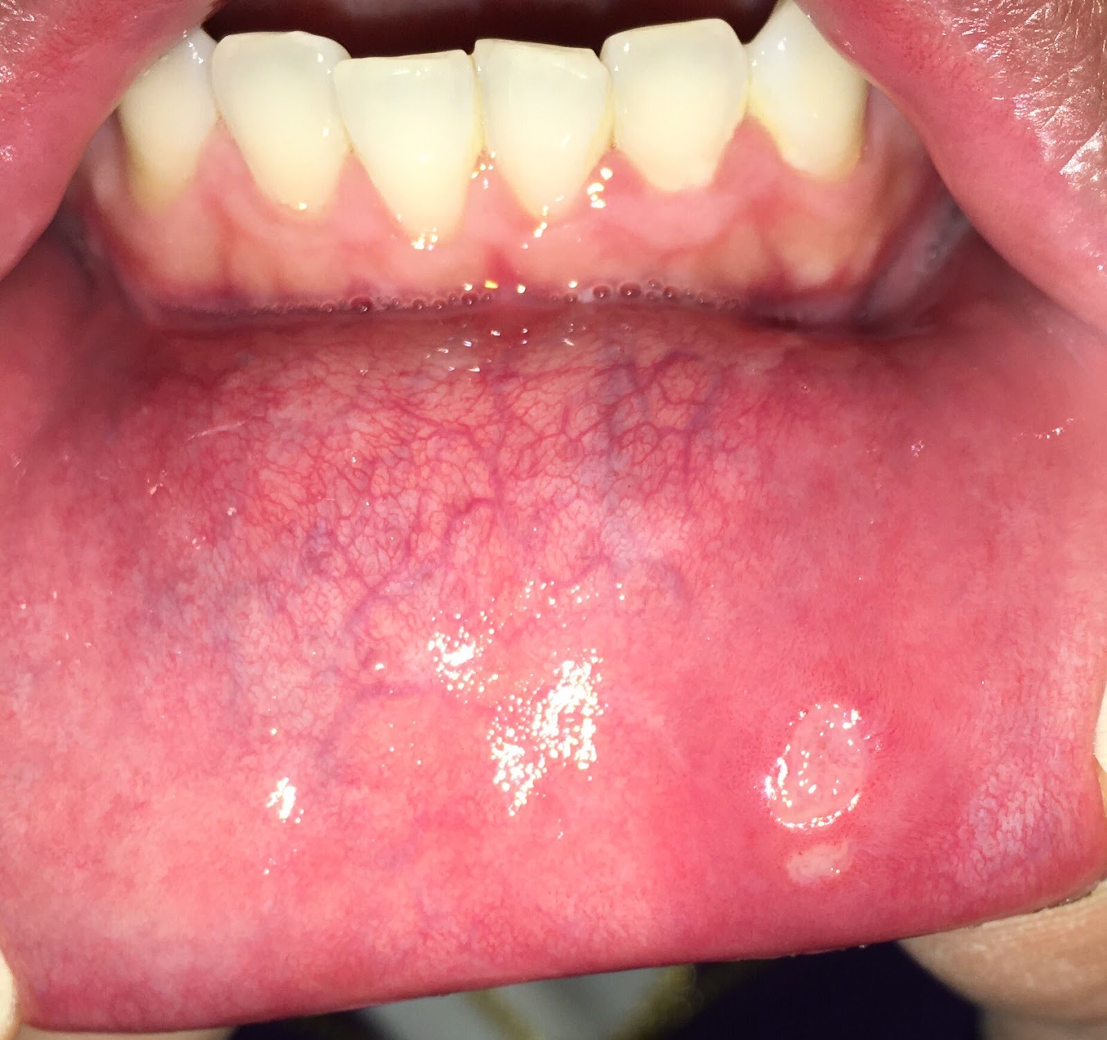 All Things Dental I Have This White Sore In My Mouth What Is It And all-things-dental-i-have-this-white-sore-in-my-mouth-what-is-it-and