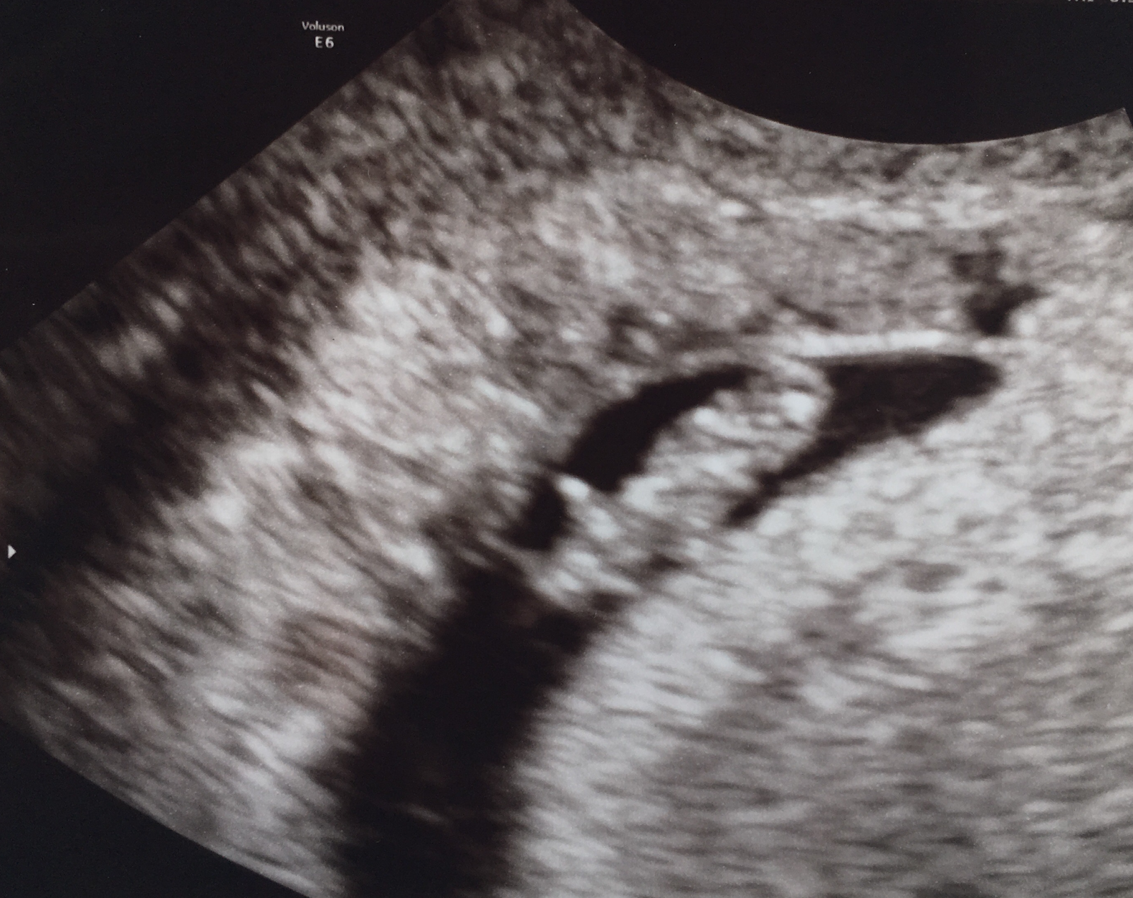A Few Good Eggs: First Ultrasound