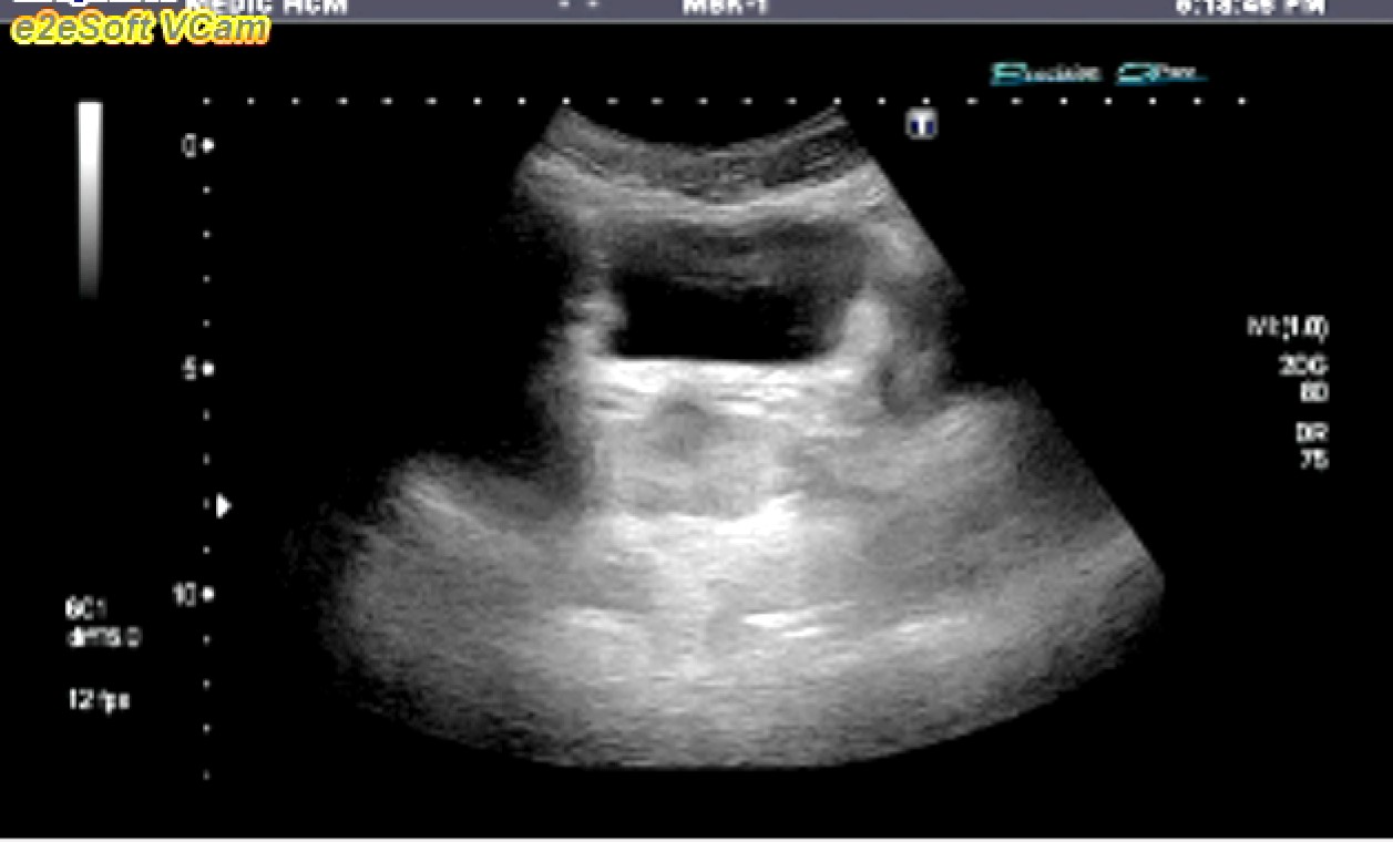 VIETNAMESE MEDIC ULTRASOUND: CASE 532: URINOMA and A 2-Year Tap Wound ...