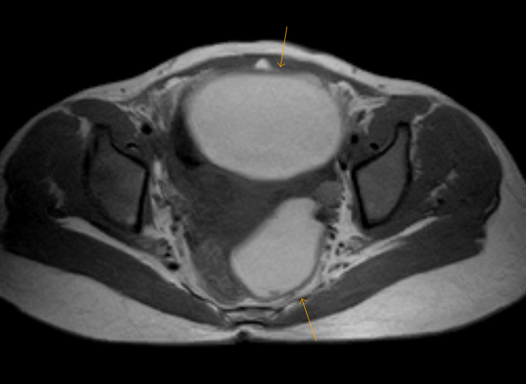 Bilateral Chocolate Cysts-MRI - Sumer's Radiology Blog