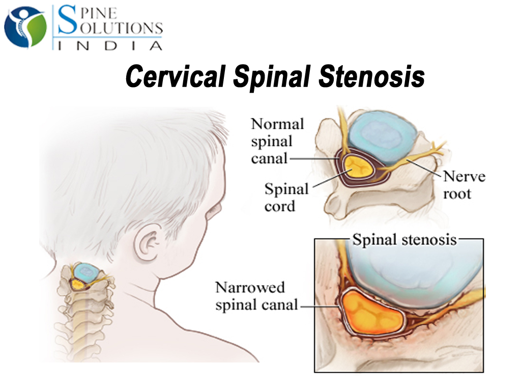 Stenosis Of Uterine Cervix Telegraph