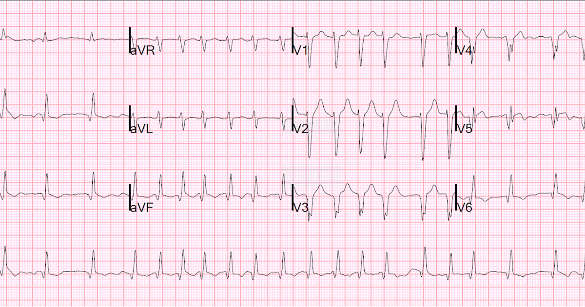 Sinus rhythm ivcd - garetblu