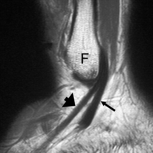 MRI Musculo-Skeletal Section: Peroneal tendon lesions.