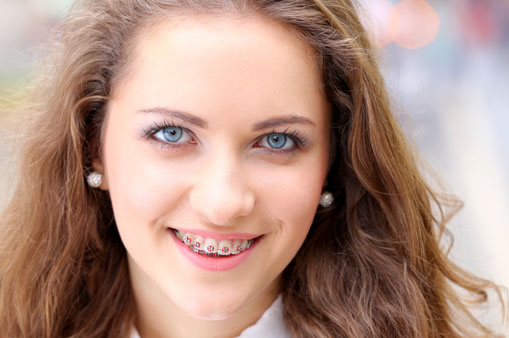 How To Look Your Best With Braces | Diva Likes