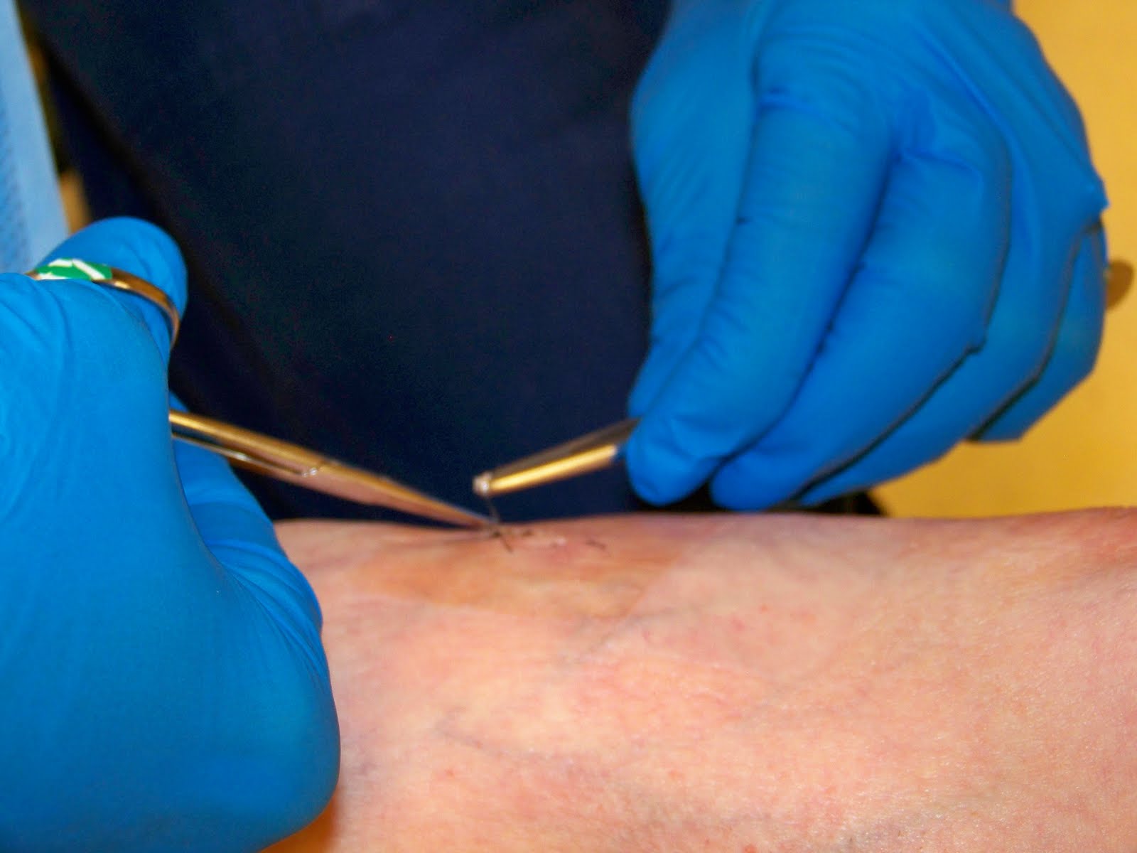 My posterior tibial tendon surgery journey: Good to go!